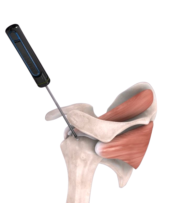 SBM | Fixit® | Ancre résorbable coiffe des rotateurs